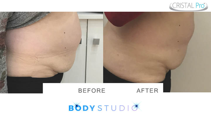 Body Contouring , Fat reduction, mommy bloom at BODY STUDIO