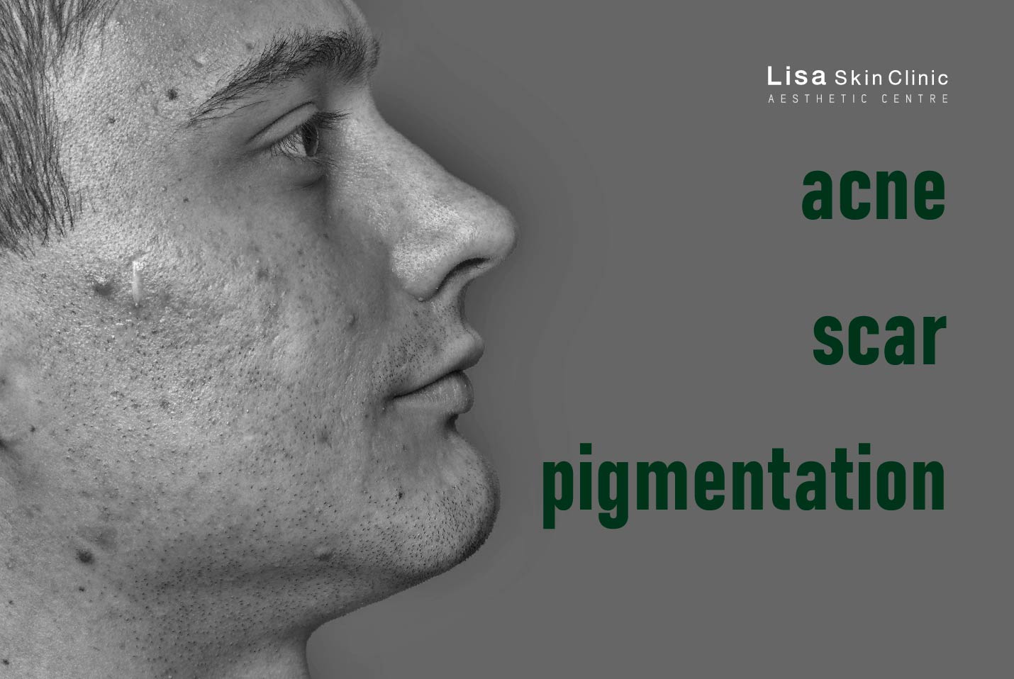 Acne, Scar, Pigmentation laser treatment at Lisa Skin Clinic